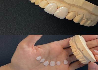 Long Lasting Dental EMAX Veneer Fabricated With All Ceramic Zirconium Material