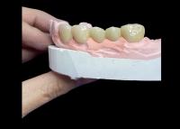 All Ceramic Crowns and Bridges Designed for Superior Aesthetics Durability and china All Ceramic Crowns and Bridges Designed for Superior Aesthetics Durability and