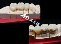 Quality OEM Precision Fit Ceramic Inlays And Onlays For Strong Natural Dental Restoration for sale