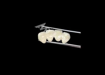 Porcelain Fused to Metal Crown with Enhanced Corrosion Resistance