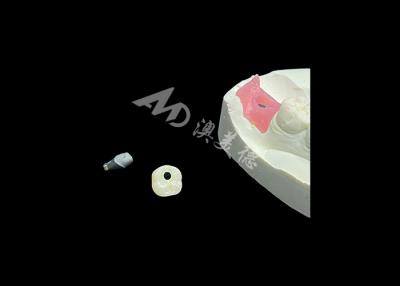 Long-lasting Dental Implant Crowns Revolutionizing Restorative Dentistry