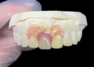 Nesbit flexible partial denture for incisors offering a seamless removable tooth