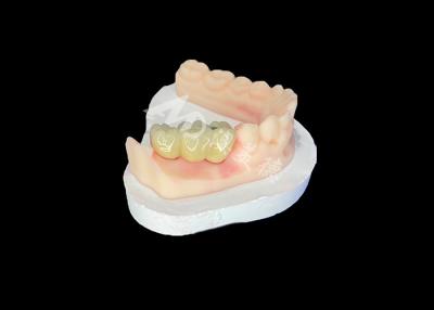 PFM Dental Crowns Lifelike and Corrosion Resistant for Optimal Oral Health
