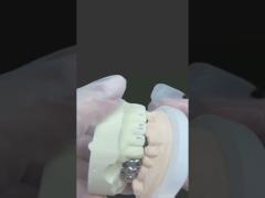Implantation dentaire en titane à couronne de plâtre à longue durée de vie pour remplacer les dents manquantes