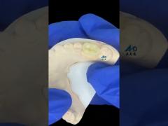 Pont dentaire en zirconium à haute translucide Forte et naturelle pour une restauration du sourire sans couture