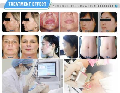 Chine Machine de laser de Vaginal Tightening Fractional Co 2/machine partielle laser de CO2 à vendre