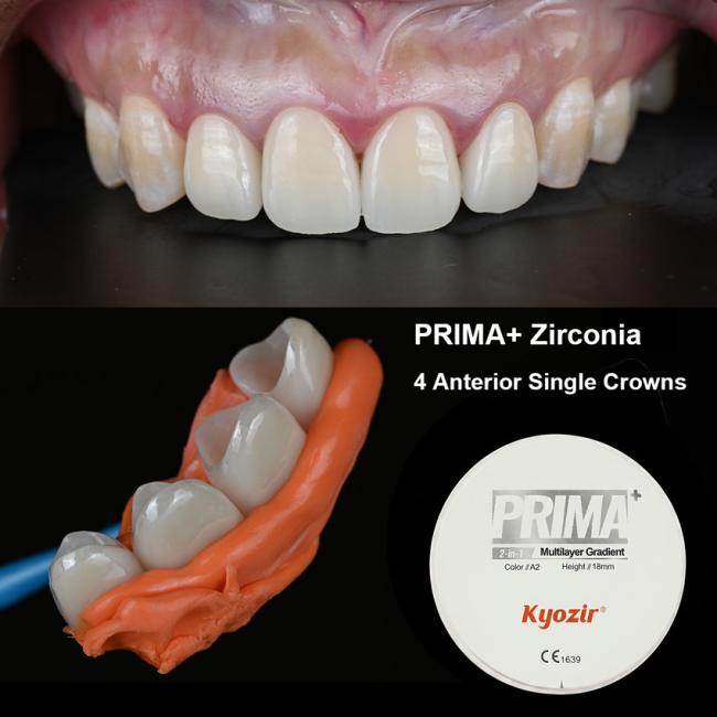 Dental laboratory zirconia crown restoration case