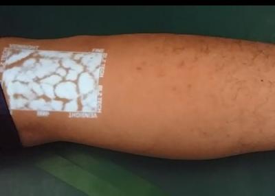 Chine Portable infrarouge Venipuncture de machine de trouveur de veine de source lumineuse de clinique pédiatrique à vendre