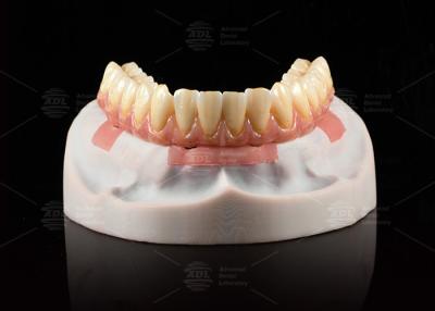 Composite Pink Porcelain Crown A1 Shade All On 4 Hybrid Titanium Screw Retained