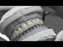 Transluzente CAD EMAX Veneer Polierte Verglaserte Keramik Restaurationen für vordere hintere Bereiche