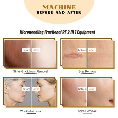 Κίνα Μηχανή RF Microneedling Laser Face Lift Μηχανή θεραπείας ουλών ακμής προς πώληση