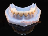 Quality Translucent And Durable PFZ Bridge Natural Porcelain Fused To Zirconia Crown for sale