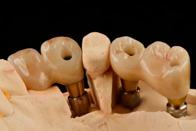 China Implante Dental de Titânio de 3,0 mm com Funcionalidade Otimizada à venda