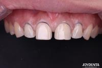 Quality Real Looking Dental Porcelain Veneers Perfectly Fit Ceramic Teeth Veneers For Front Teeth for sale