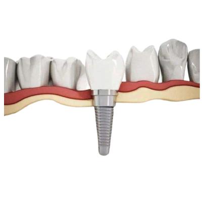 Implant dentaire titanique durable haut Biocompatibility anticorrosion