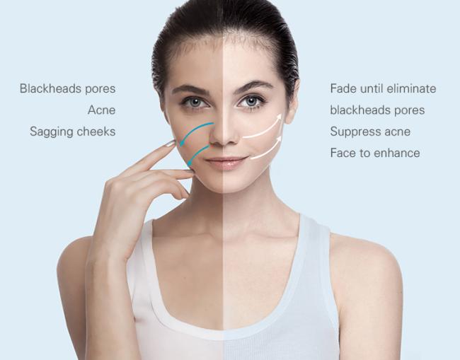 Skin Guardian!! IPL laser hair removal / IPL Skin Rejuvenation Machine Price / IPL machine price with CE from Weifang KM