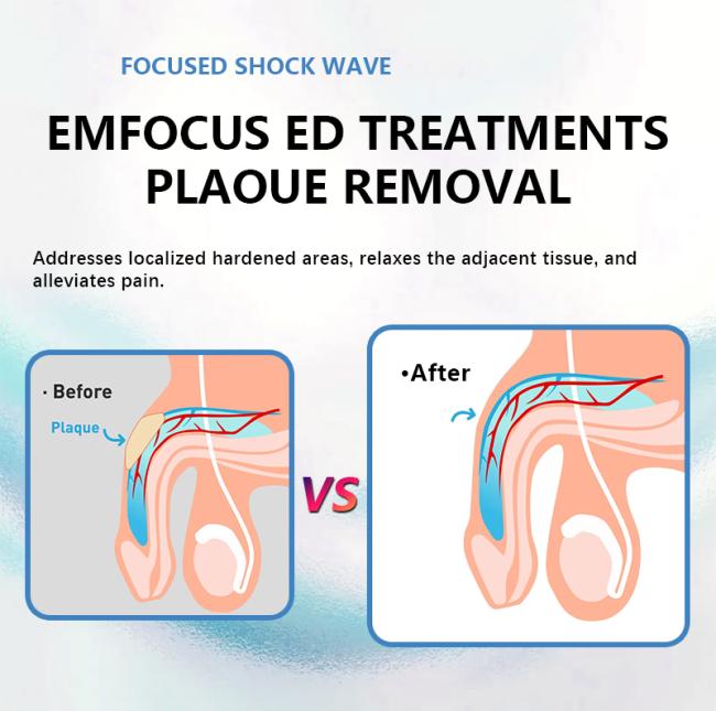 Focused Shock Wave Therapy Machine - Principle Diagram