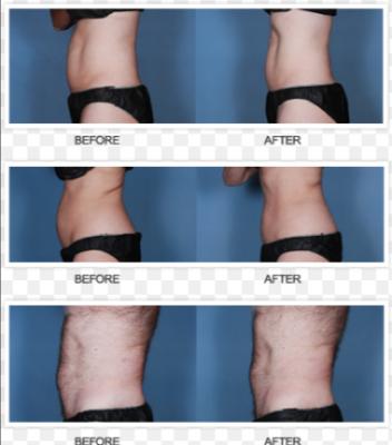 중국 Mchine의 초음파 성형수술 기계를 체중을 줄이는 고강도 집중된 초음파 Liposonix 판매용