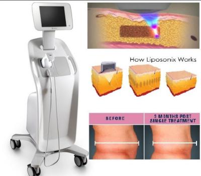 중국 Mchine의 초음파 성형수술 기계를 체중을 줄이는 고강도 집중된 초음파 Liposonix 판매용