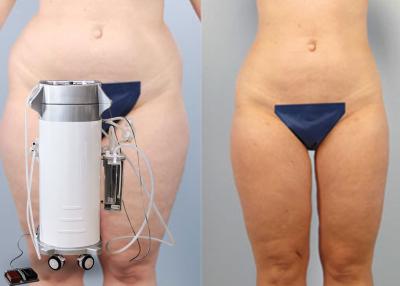 Κίνα Το λίπος/η δύναμη μείωσης Cellulite βοήθησε τον εξοπλισμό ομορφιάς αδυνατίσματος με την ελεύθερη κενή αντλία πετρελαίου προς πώληση