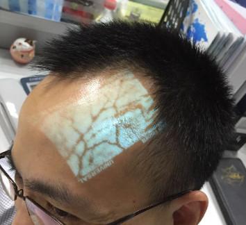中国 Phlebotomyのための医学の専門の赤外線静脈の視聴者のTransilluminatorの発見の静脈 販売のため