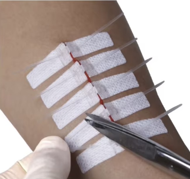 Self-Adhesive Dermaclip wound closure device - front view