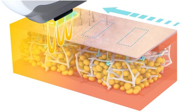 Máquina rápida do laser da remoção do cabelo do IPL SHR do Permanent para o salpico da epiderme
