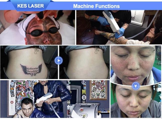 laser tattoo removal machine3