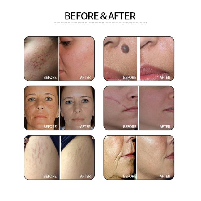 CO2 laser scar removal treatment