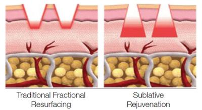 중국 모든 피부 유형을 위한 혁신적인 피부 재구성 및 얼굴 외관 기술 판매용