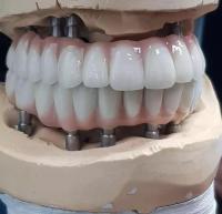 Quality Precision-Crafted Zirconia Implant Screw Cement Retained for Natural-Looking Teeth for sale