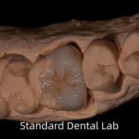 Quality Translucency Emax Zirconia Dental Inlay Onlay Crown For Restore Natural Cavity Shape for sale
