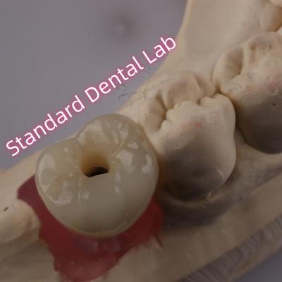 중국 스루브로 고정된 치아 임플란트 크라운 PFZ 포스텔렌 층 지르코니아 판매용