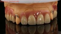 Quality Heat Cured Ivoclar Partial Acrylic Denture Dental Lab High Accuracy with 3D print model for sale