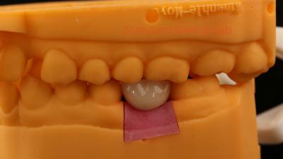 중국 스크루 유지 된 PFZ 포르셀린 층 지르코니아 치아 임플란트 왕관 치아 연구소 ISO FDA CE 인증 5 년 보증 판매용