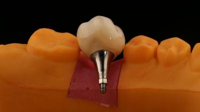 중국 스크루 유지 된 PFZ 포르셀린 층 지르코니아 치아 임플란트 왕관 치아 연구소 ISO FDA CE 인증 5 년 보증 판매용