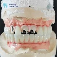 Quality Titanium Malo Bridge Implant Bridge Without Multi Unit Abutment Cementable for sale