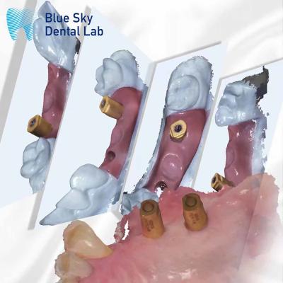 China Scan Body All In One Dental Healing Capsule Blue Sky Implant System for sale