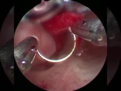 Όργανα Myoma Gyn Submucous, διπολικός έλεγχος οργάνων γυναικολογίας χειρουργικός