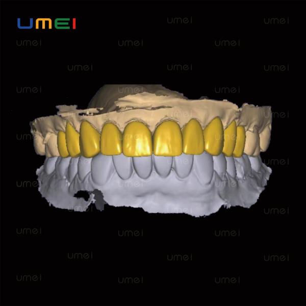 Quality Minimally Invasive Durable Dental Veneer Bespoke CAD Design Solutions for sale