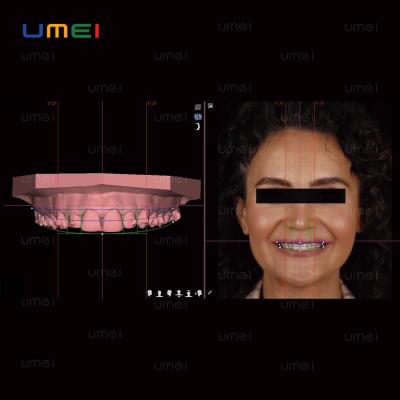 China Aesthetic Digital Smile Design DSD Stain Resistant Dental Digital Smile Design for sale