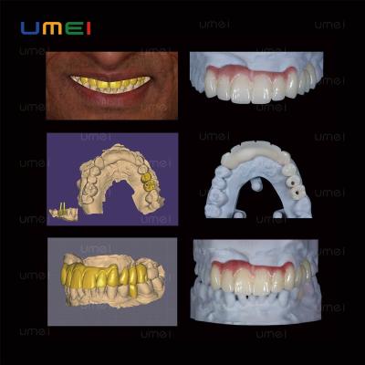 China Digital Implant & Aesthetic Restoration Workflow -Seamless Functional & Aesthetic Integration-Patient-Centric Workflow for sale