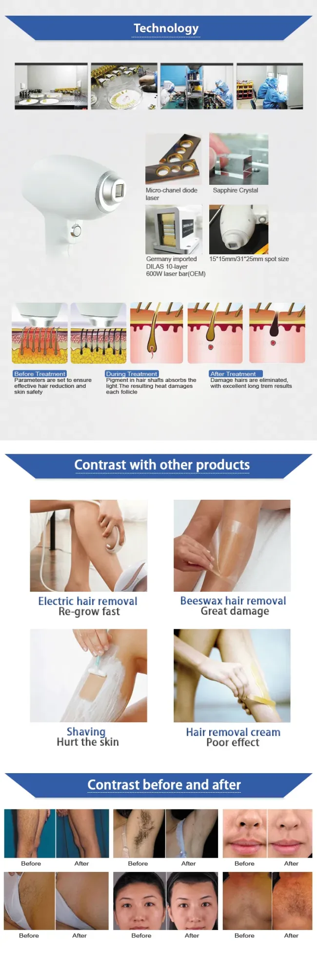 Laser Hair Removal Treatment