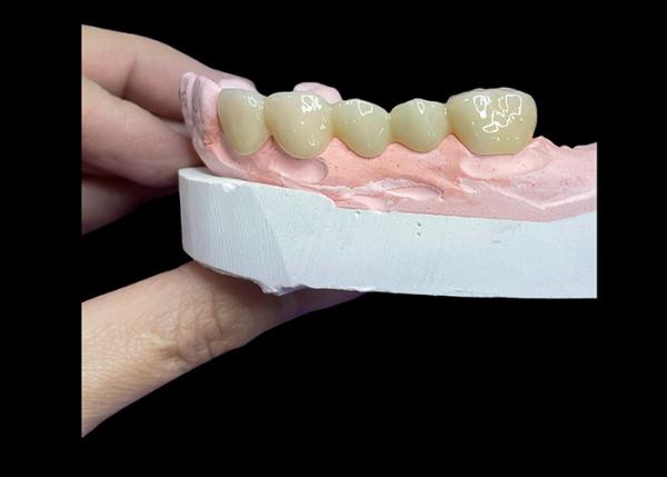 Quality All Ceramic Crowns and Bridges Designed for Superior Aesthetics Durability and for sale