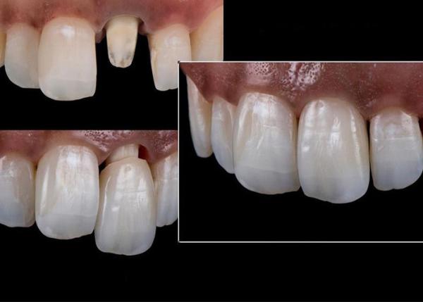 Quality All Ceramic Crowns and Bridges Designed for Superior Aesthetics Durability and for sale
