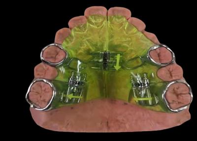 Cina Mouthpieces Dental Tooth Apparecchi ortodontici, Legature ortodontiche in vendita