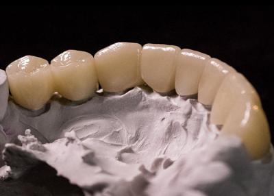 China Porselein gesmolten met metalen kronen - Geavanceerde technologie voor langdurige glimlachherstel for sale
