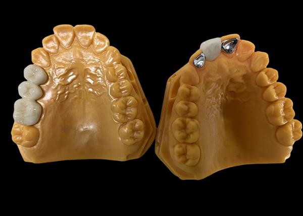 Quality Moderate Translucency Porcelain Fused To Metal PFM Crown , PFM Ceramic Crown for sale