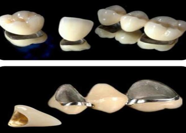 Quality Moderate Translucency Porcelain Fused To Metal PFM Crown , PFM Ceramic Crown for sale