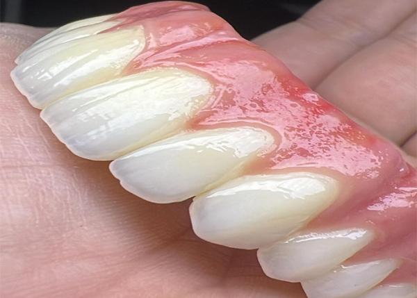 Quality Oral Health Dental Implant Supported dentures Bridge Polished Surface Supporting for sale
